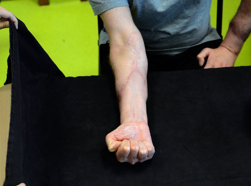 NHS patients to receive first hand and arm transplants | The ...