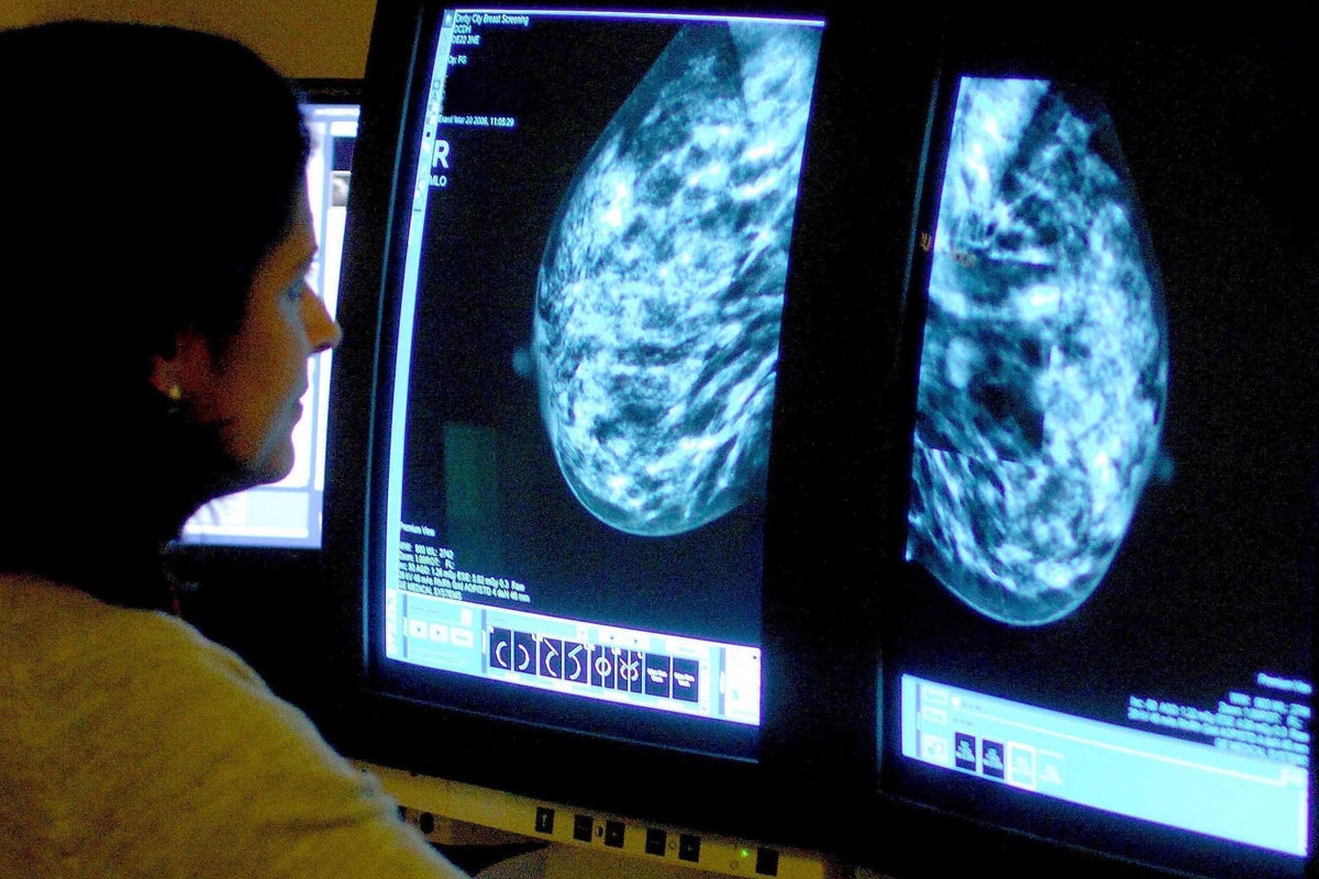 Woman shares photo of her breast to show what cancer symptoms look like ...