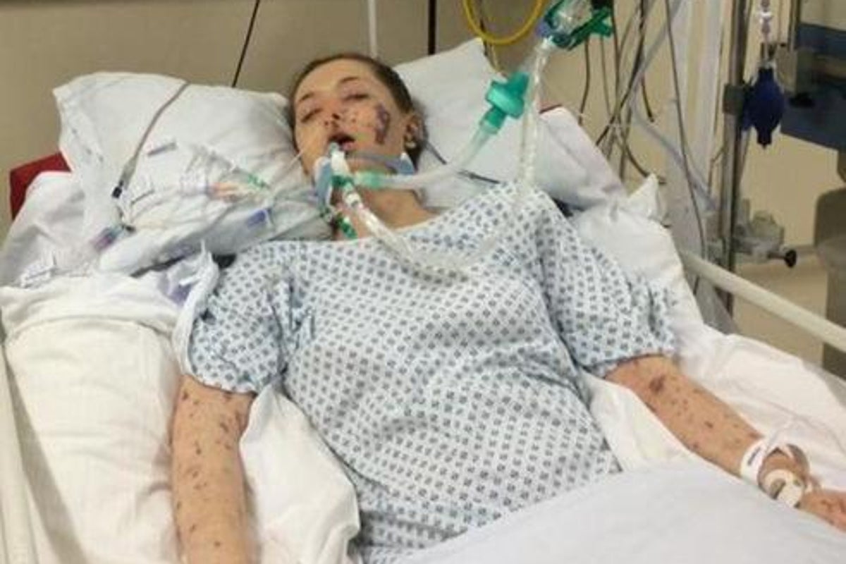 Teenager with meningitis shares graphic photos of rash to raise ...