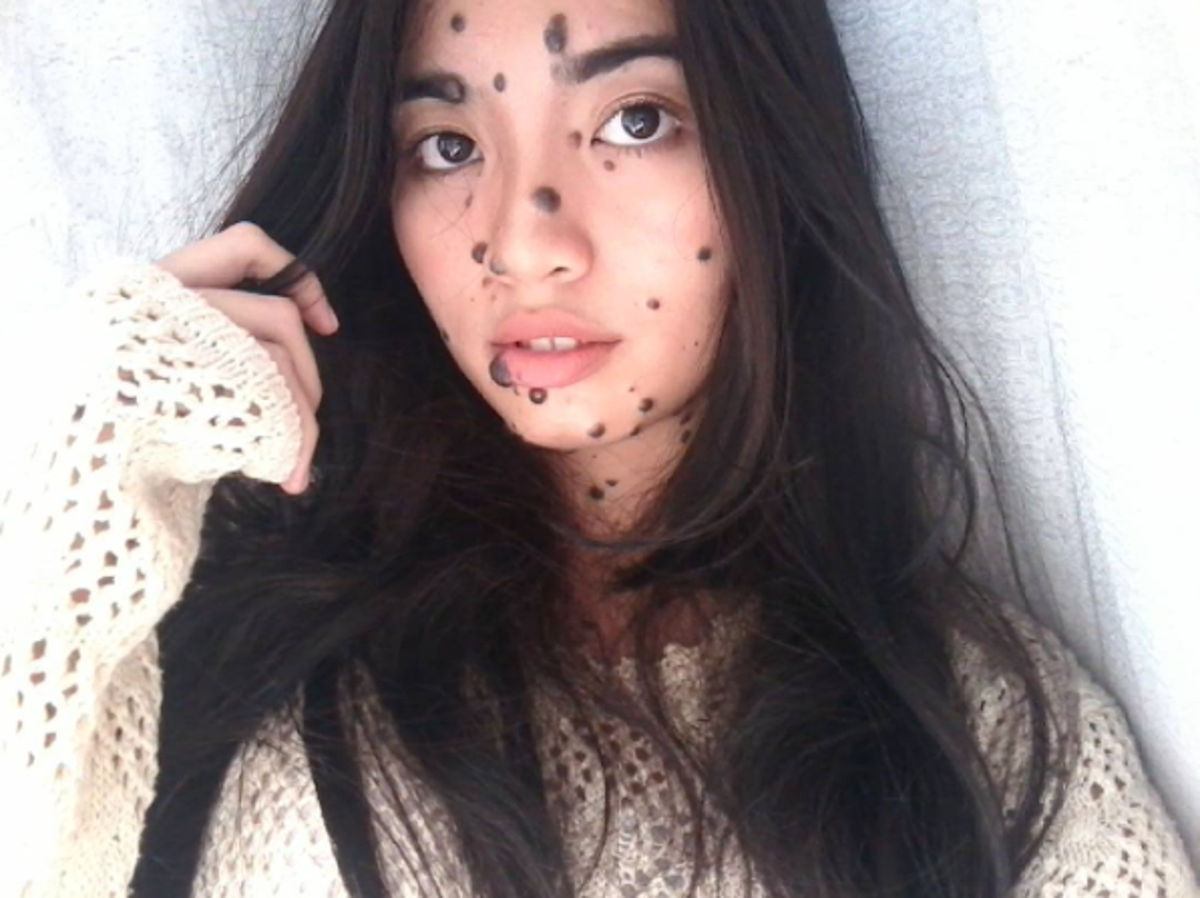 Woman Bullied For Head To Toe Moles Could Be Crowned The Next Miss