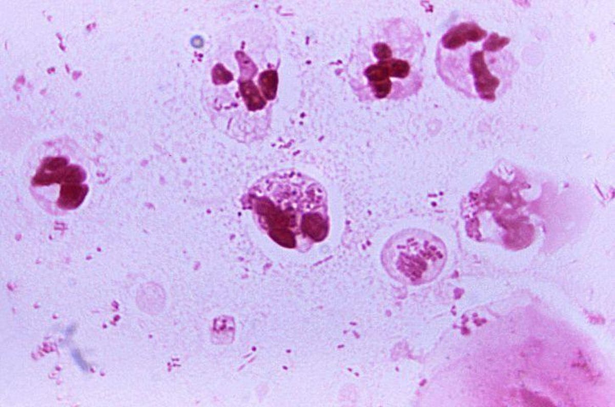 How the throat acts as a ‘silent reservoir’ for gonorrhoea | The ...