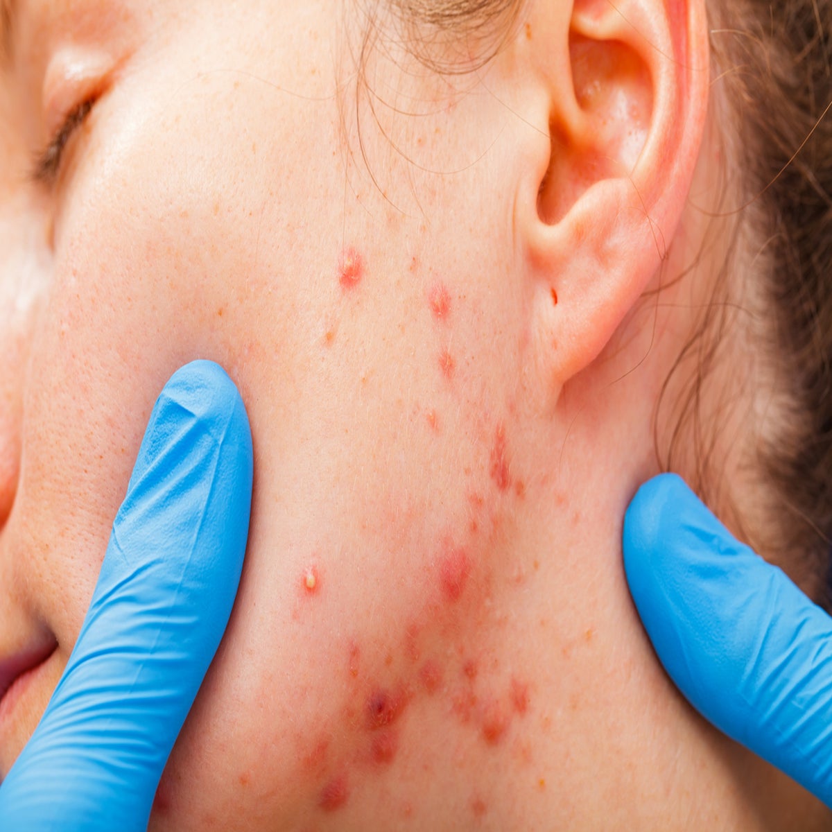 can tetracycline cause acne