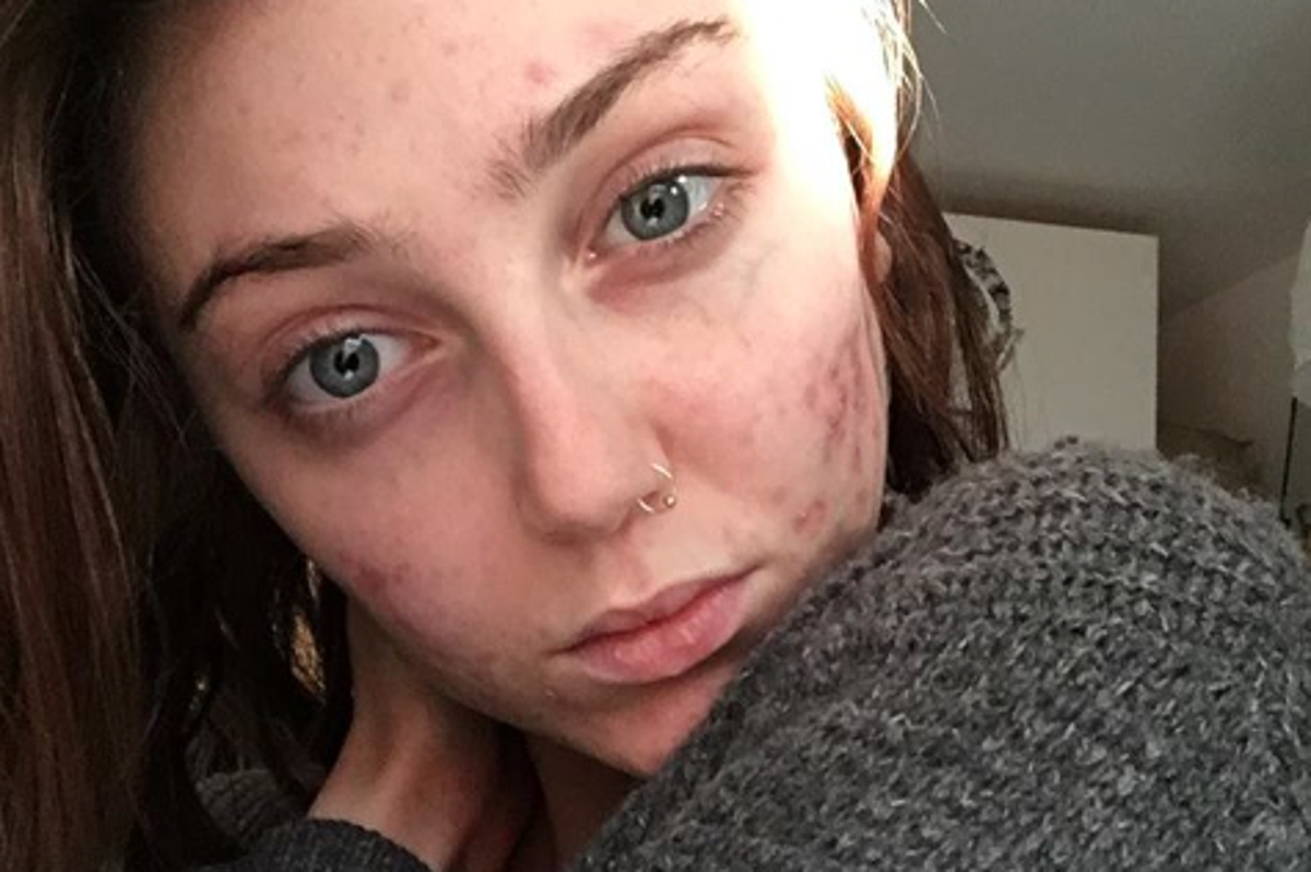 #FreeThePimple: Model launches campaign to encourage women to share ...