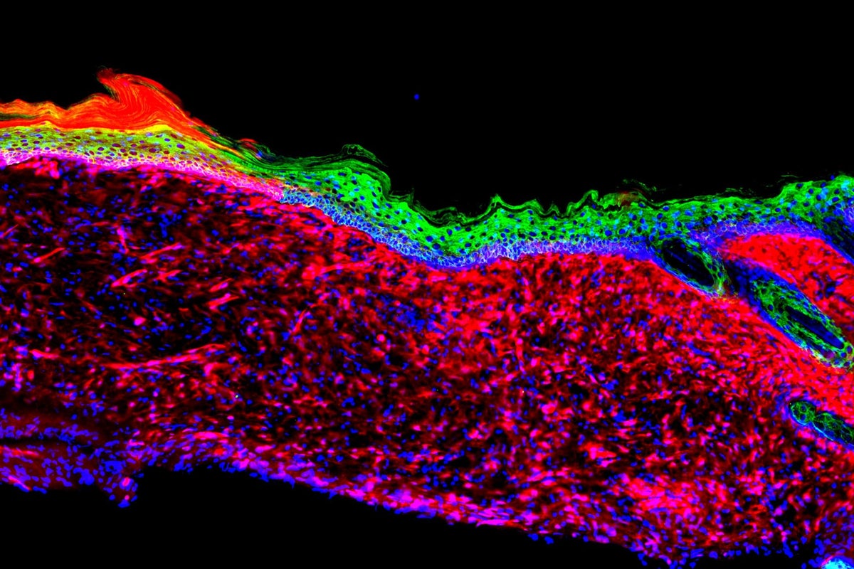 Open wounds converted into healthy skin in scientific first | The ...