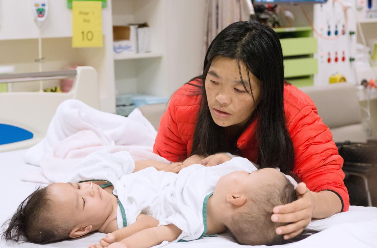 Conjoined twins who shared a liver separated in six-hour operation by ...