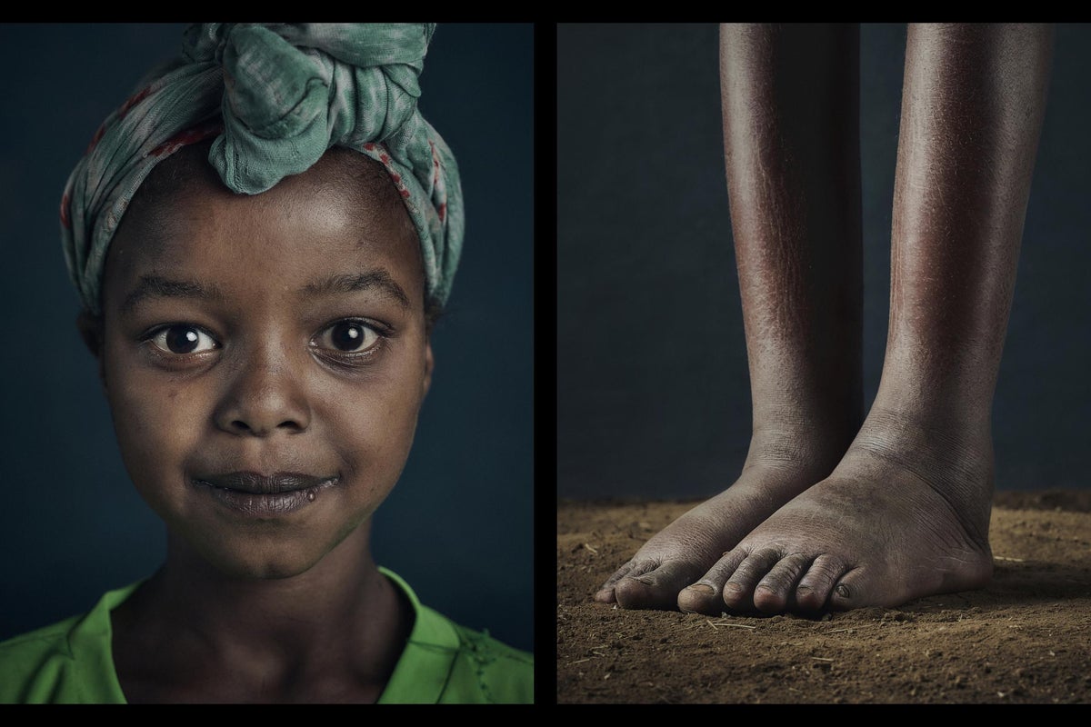Podo: The invisible tragedy | The Independent | The Independent