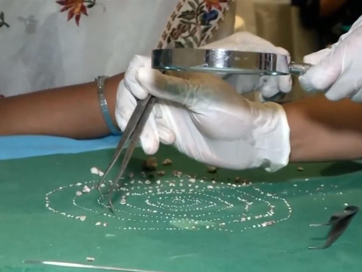 Child has 526 ‘teeth’ removed from mouth | The Independent | The ...