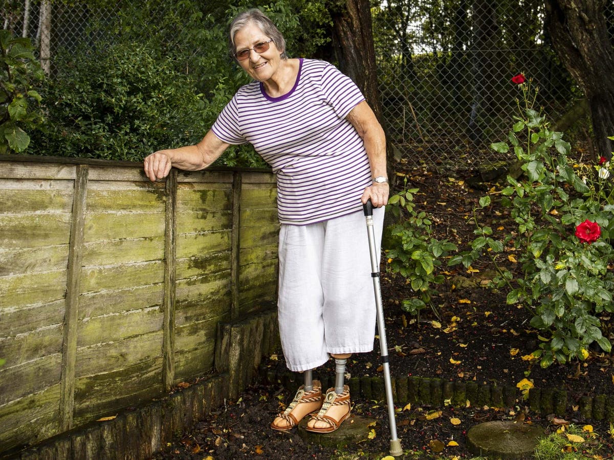 Woman bitten by mystery insect has legs and fingertips amputated after ...