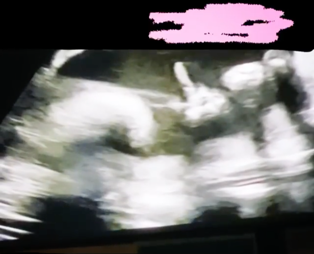 Katy Perry shares sonogram that appears to show baby putting up middle ...